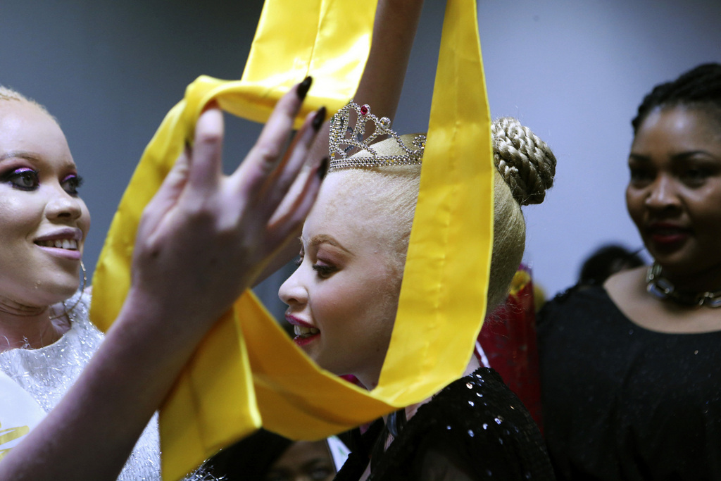 Zimbabwe Albinism Pageant | AFRO American Newspapers